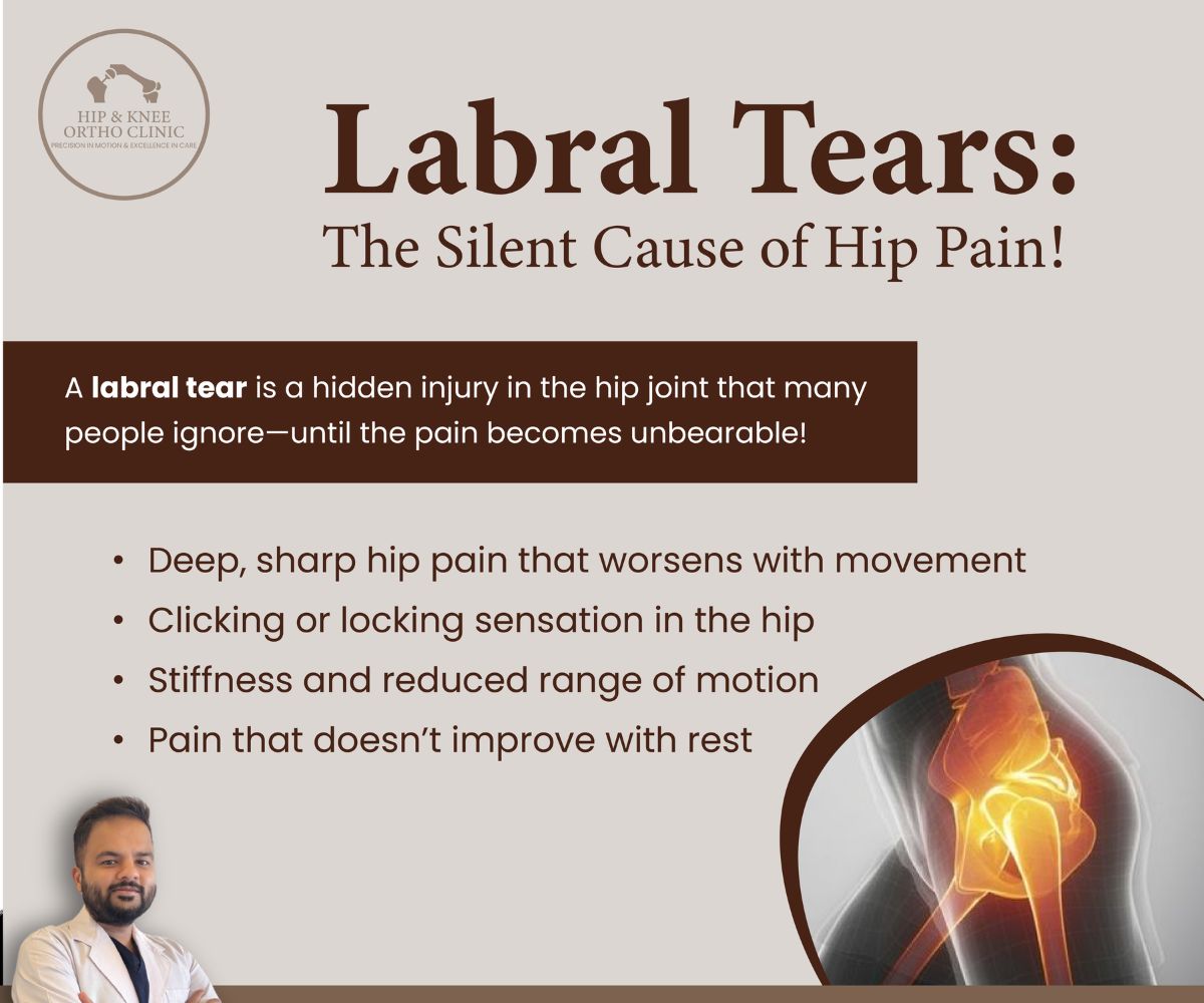 Labral Tear: The Silent Cause of Hip Pain!